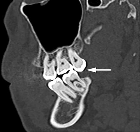 Sagittal Ct Image Shows Overeruption Of The Maxillary Third Molar