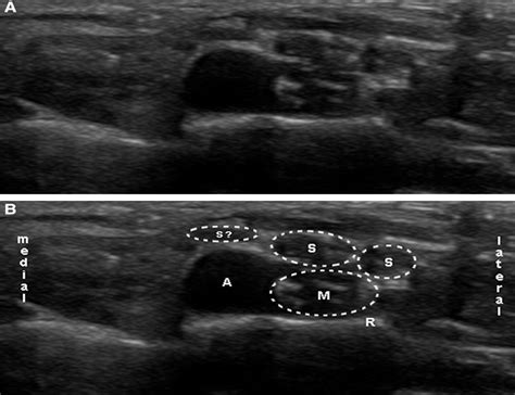 A Randomized Comparison Between Double Injection And Targete Anesthesia And Analgesia