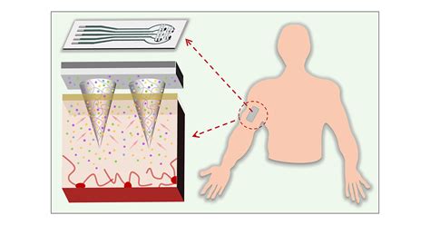 Microneedle Coupled Epidermal Sensors For In Situ Multiplexed Ion