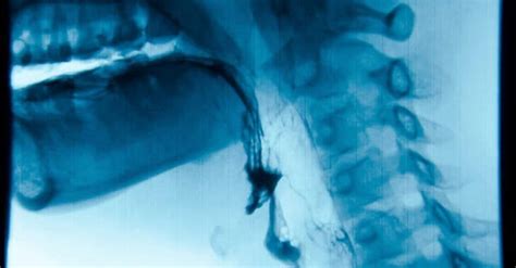 Fluoroscopy Esophagram Complete With Double Contrast Average Joe Weekly