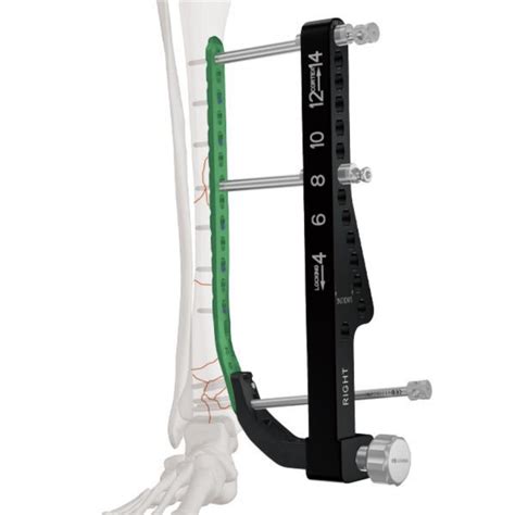 Placa Bloqueada Tibial Distal Medial De Perfil Bajo Aravon Medical