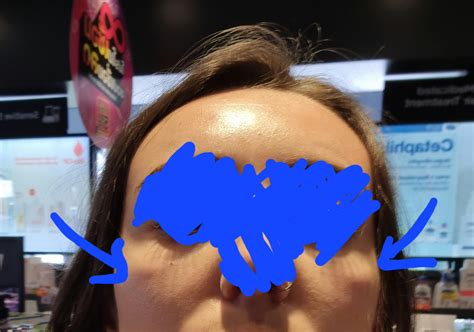 Bleph Cheek Lift Or Something Else Rplasticsurgery