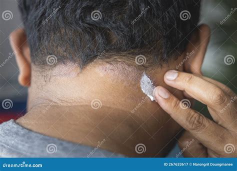Dark Skinned Asian Men Apply Skin Treatment Suffer From Scalp Dermatitis Due To Moisture Causing