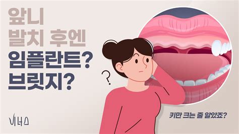 앞니 발치 후 임플란트가 좋을까 브릿지가 좋을까 I 임플란트 실패를 피하기 위한 환자 나이별 선택 I 앞니 치과 비너스 원장의 앞니 치료 이야기 Youtube