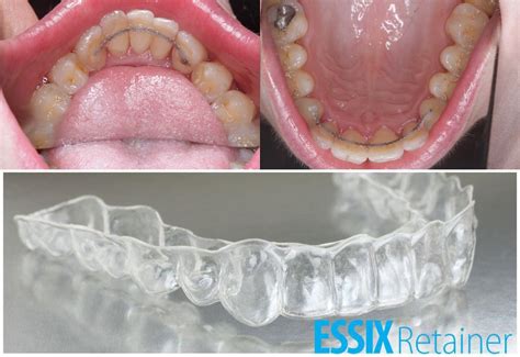 What Does An Essix Retainer Look Like At Alyssa Geddes Blog