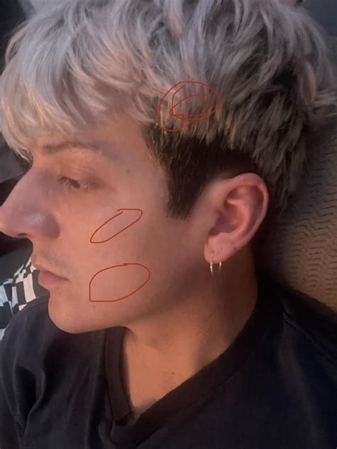 Trigeminal Neuralgia And Migraines R Trigeminalneuralgia