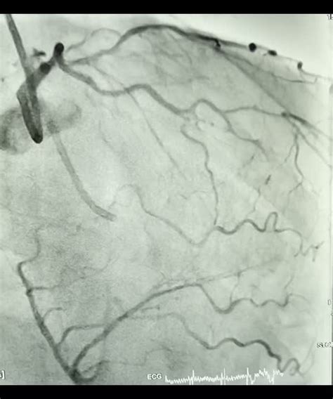 Zul Hilmi Yaakob On Linkedin Pci To Long Cto Lad Antegrade Approach Gaia Next One Fine Cross
