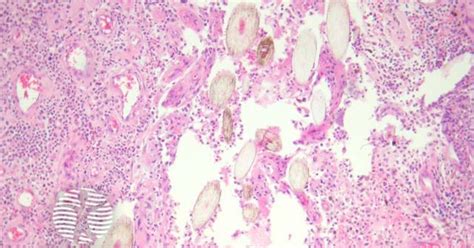 Dermnet® Pilonidal Sinus Pathology Image