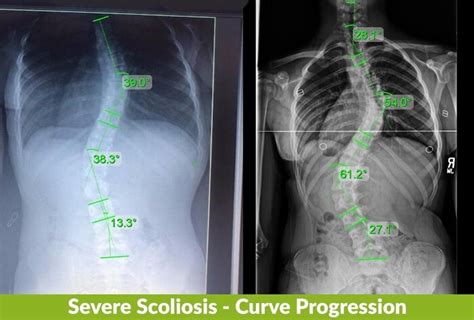 Severe Scoliosis Symptoms Treatment And Surgery