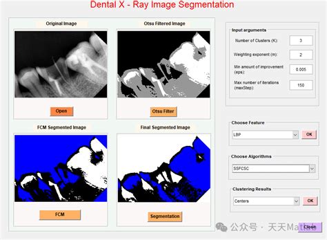 【图像分割】基于半监督模糊聚类模糊实现牙科x射线图像分割附matlab代码多模态口腔分割算法 Csdn博客