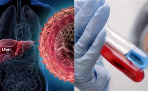 Элэгний В С вирусийн илрүүлэг шинжилгээ маргааш эхэлнэ