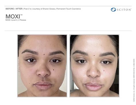 Moxi Laser Treatment Denver Co Laser Treatment Denver