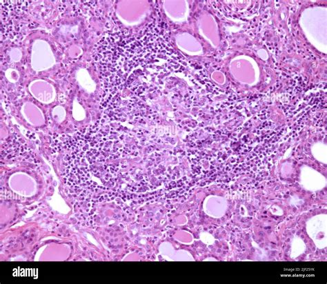 Light Micrograph Of A Human Thyroid With Chronic Thyroiditis Hashimoto
