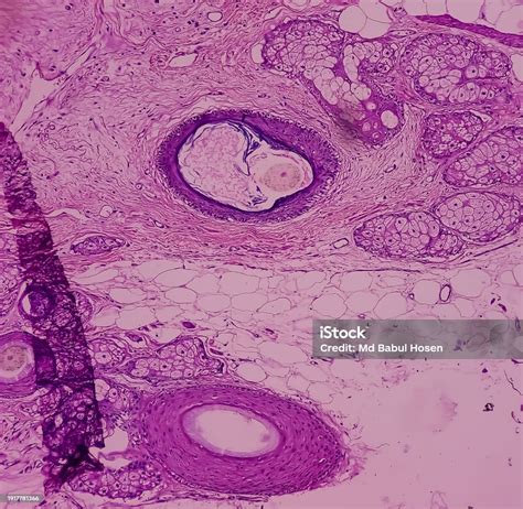 Mature Cystic Teratoma Ovarian Cyst Biopsy Show Cyst Wall Of Skin And