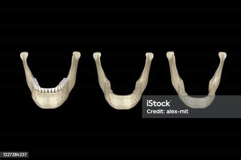 하악턱 치아를 잃은 후 뼈 침체 의학적으로 정확한 치과 3d 일러스트레이션 감소에 대한 스톡 사진 및 기타 이미지 감소 개선 건강관리와 의술 Istock