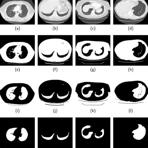 Cellular Nsip Pattern The Multiplanar Axial A And Coronal B Download Scientific Diagram