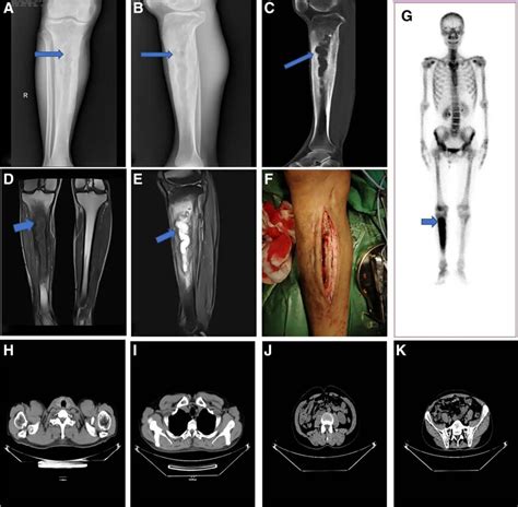 A And B Anteroposterior And Lateral Radiographic Views Of The Download Scientific Diagram