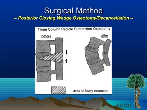 Posterior Closing Wedge Osteotomy Decancellation And Instrumentation