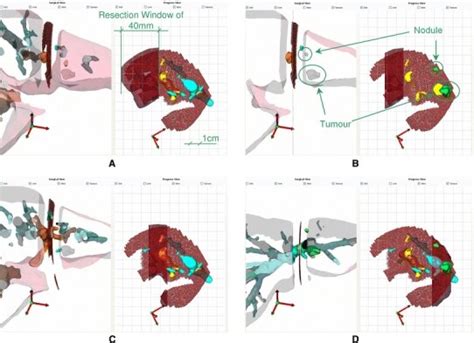 Internal View Of The Resection Map Showing Some Of Its Visualization Download Scientific