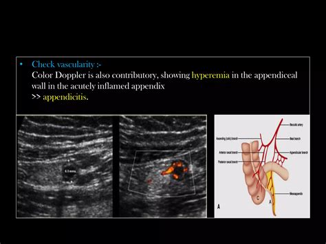 Emergency Ultrasound Course Lecture 04 Acute Appendicitis Part 1 Pdf