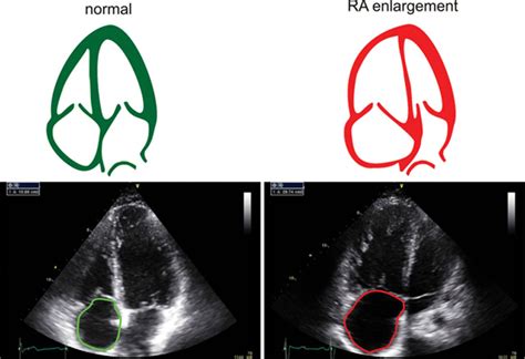 Reference Values For And Determinants Of Right Atrial Area In Healthy