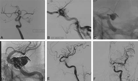 Figure 1 From Casescarotid Cavernous Fistulas A Report Of 23 Balloon Assisted Embolization Of