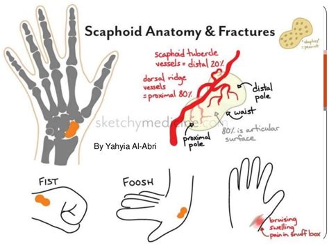 Scaphoid Fractures