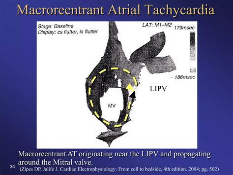 Atrial Tachycardia Pdf