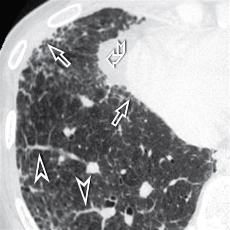 Computed Tomography Of Diffuse Lung Diseases And Solitary Pulmonary