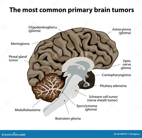 The Most Common Primary Brain Tumors Stock Vector Illustration Of