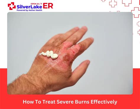 How To Treat Severe Burns Emergency Care First Aid And Medical Treatment