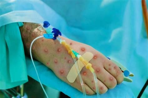 Who Declares Mpox No Longer A Global Health Emergency News18