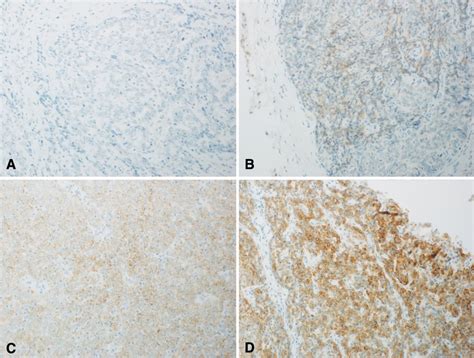 Fgfr2 Iiib Ihc Staining With Antibody Clone 98706 Randd Systems Fgfr2