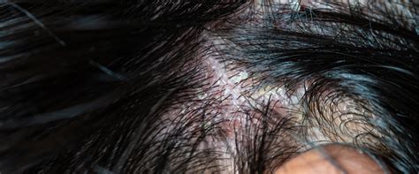 How To Get Rid Of Scalp Acne Ellatu
