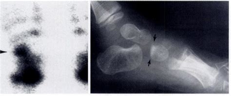 Cuhoid Fracture A Dorsoplantar Radiograph Shows Minimal Cortical