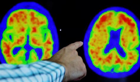 Alzheimers Diagnosis Revamp Embraces Rating Scale Similar To Cancer Gma News Online