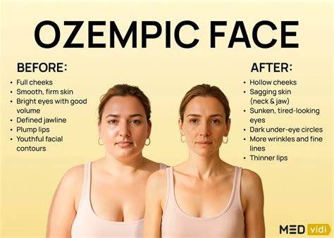 “ozempic Face” And Facial Ageing After Rapid Weight Loss What It Is And