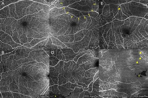 Deep Learning For Quality Assessment Of Optical Coherence Tomography Angiography Images