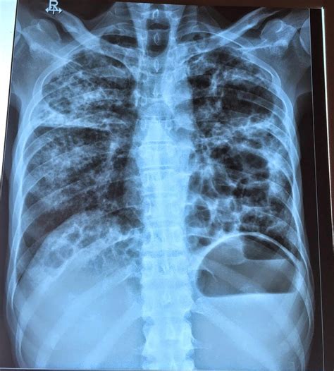 Chest Archives Chest X Ray Bronchiectasis