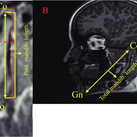 Constructions And Both Linear Measurements Of Posterior Mandibular Download Scientific Diagram