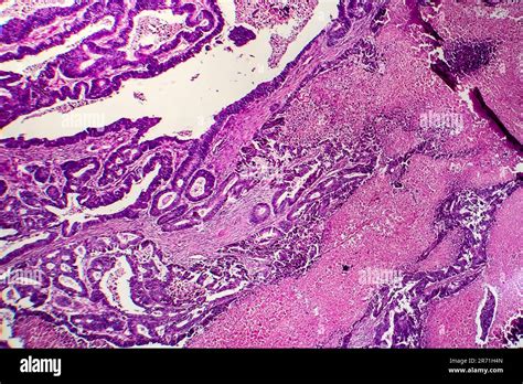 Differentiated Intestinal Adenocarcinoma Light Micrograph Photo Under