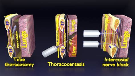 Thorax Thoracotomy Thoracocentesis Intercostal Nerve Block 3d Model