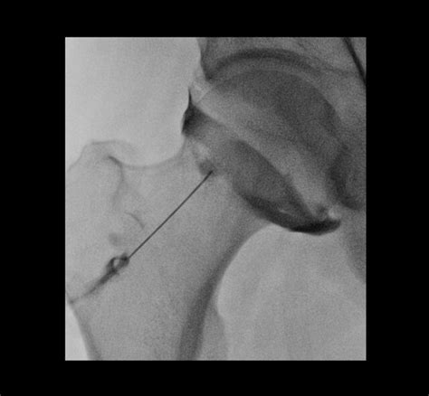 Radiopaedia Case Hip Arthrogram Injection Fluoroscopic Guided Id