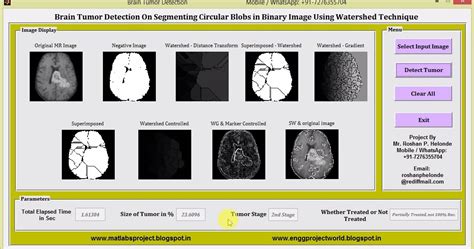 Brain Tumor Detection Using Watershed Technique Matlab Project With Source Code ~ Engineering