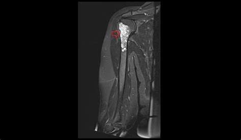 Mri Upper Arm Pathologies Radiology Articles On Humerus Pathologies