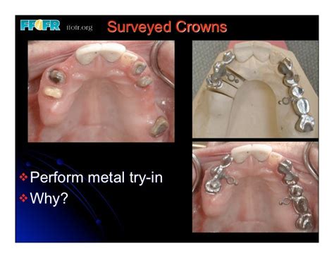 12 New Surveyed Crowns And Combined Fixed Rpd Cases
