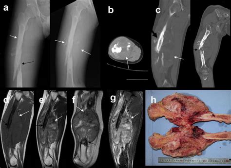 Primary Diaphyseal Osteosarcoma In Long Bones Imaging Features And