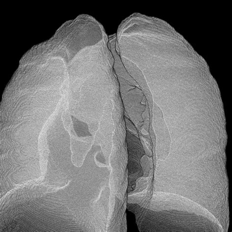 Finding And Measuring Lungs In CT Data Kaggle