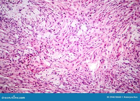 Photomicrograph Of A Giant Cell Tumor Of Bone Revealing Its Cellular