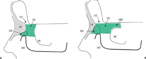 Anatomy Of The Frontal Recess And Frontal Sinus With Three Dimensional Reconstruction Ento Key